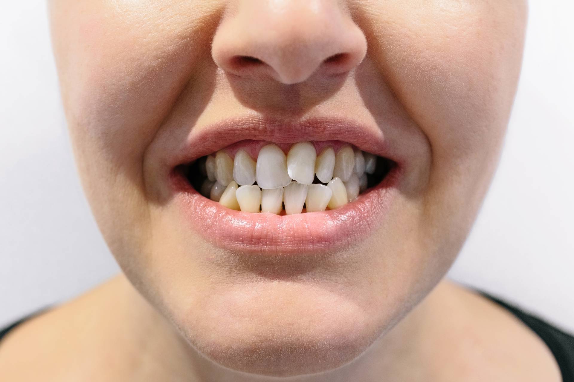 Malocclusione dentale: che cos’è e come si cura - Sportiva Mens